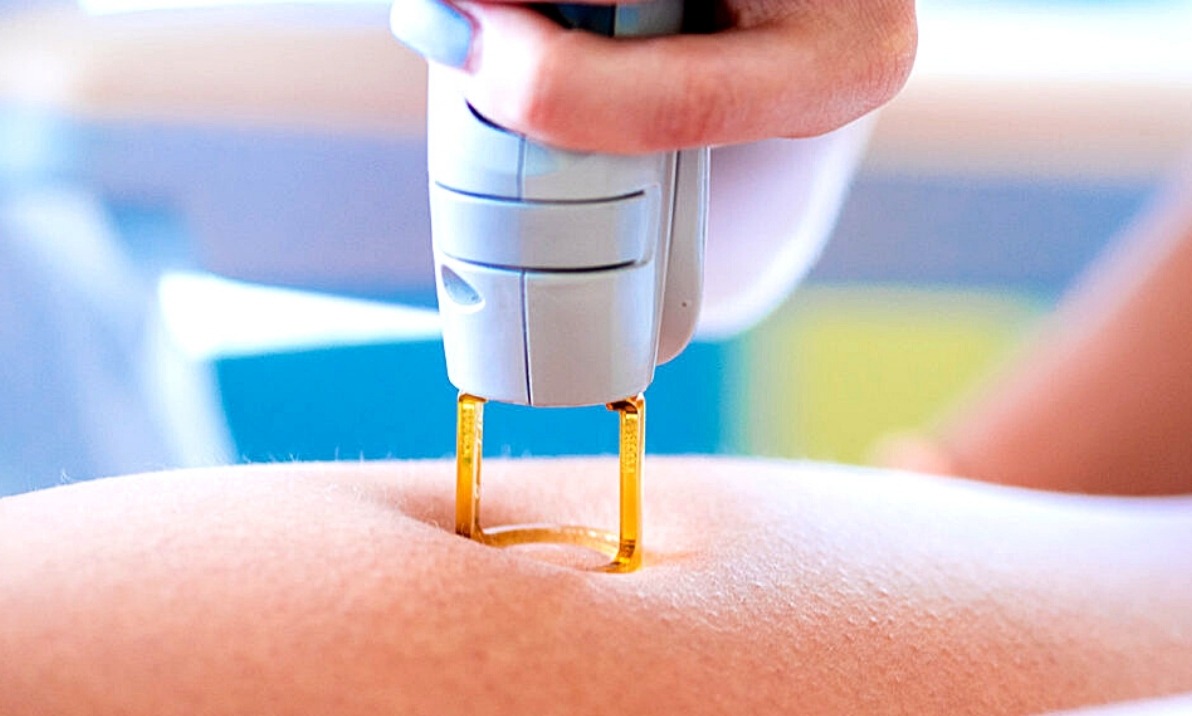 Laser Hair Removal: Getting to the Root of it - Scoop Empire